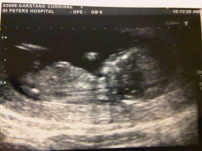 A Record of My Pregnancy: Scan 12 weeks, 4 days
